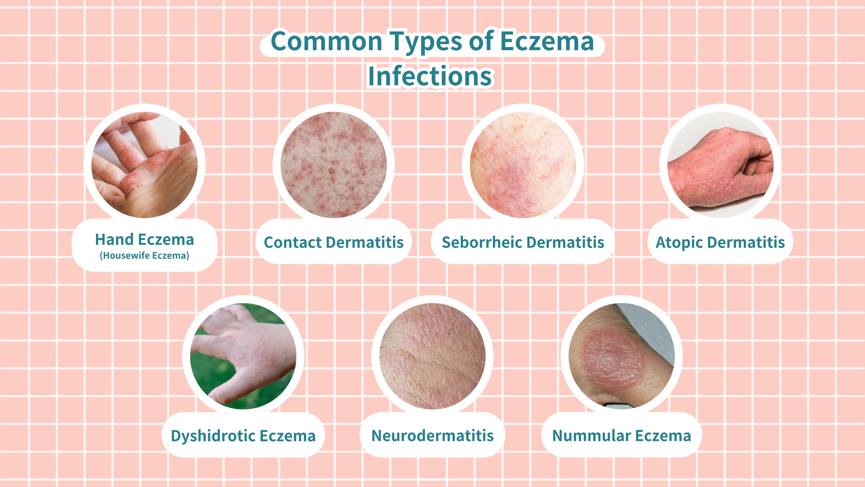 Can You Overcome Eczema Without Steroids?