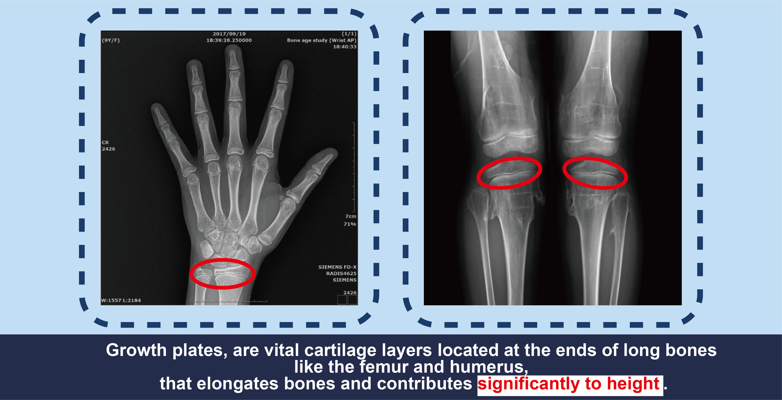 A Deep Dive into Growth Plates and Height | Tenchi Health Tips